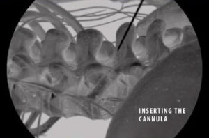 Lumbar Radiofrequency Neurotomy - Spine & Orthopedic Center