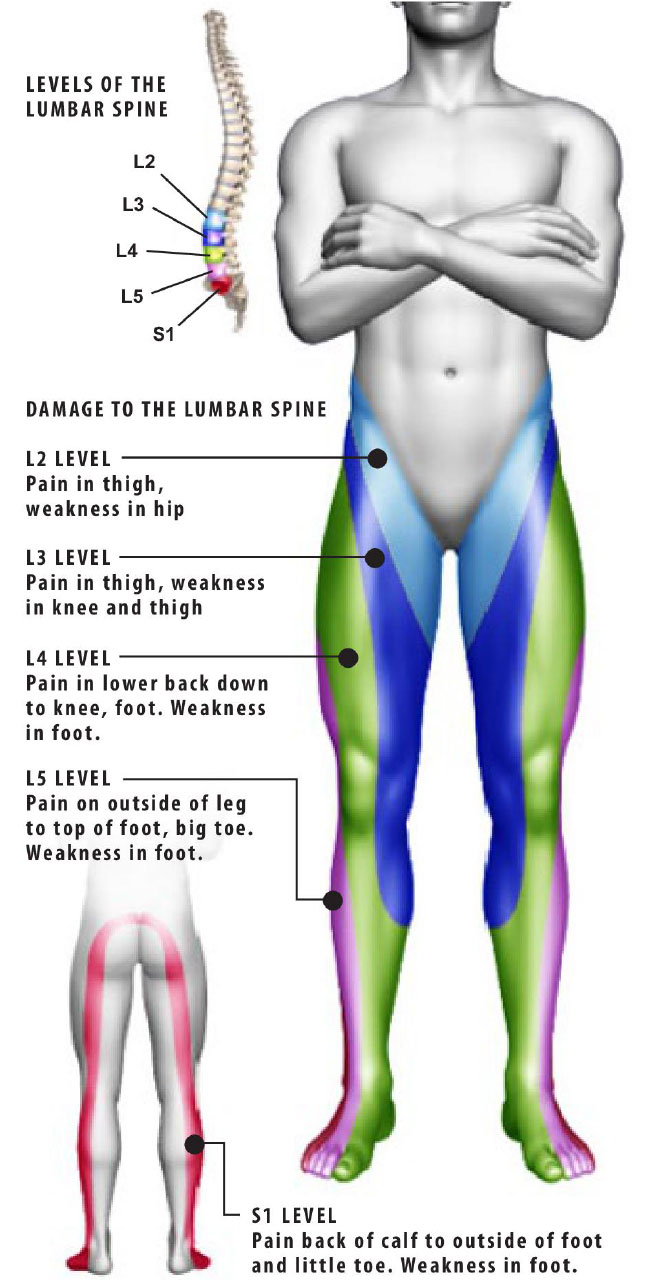 Lumbar Radiculopathy Spine And Orthopedic Center 0241