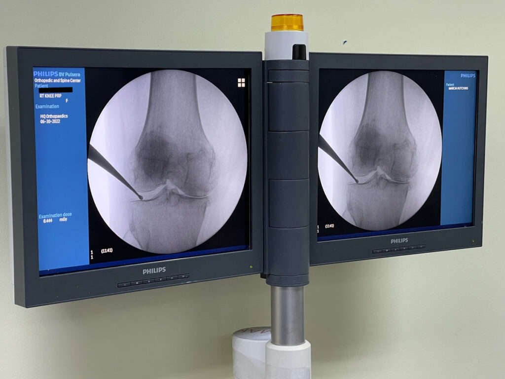 Platelet-Rich Plasma (PRP) Therapy - Spine & Orthopedic Center