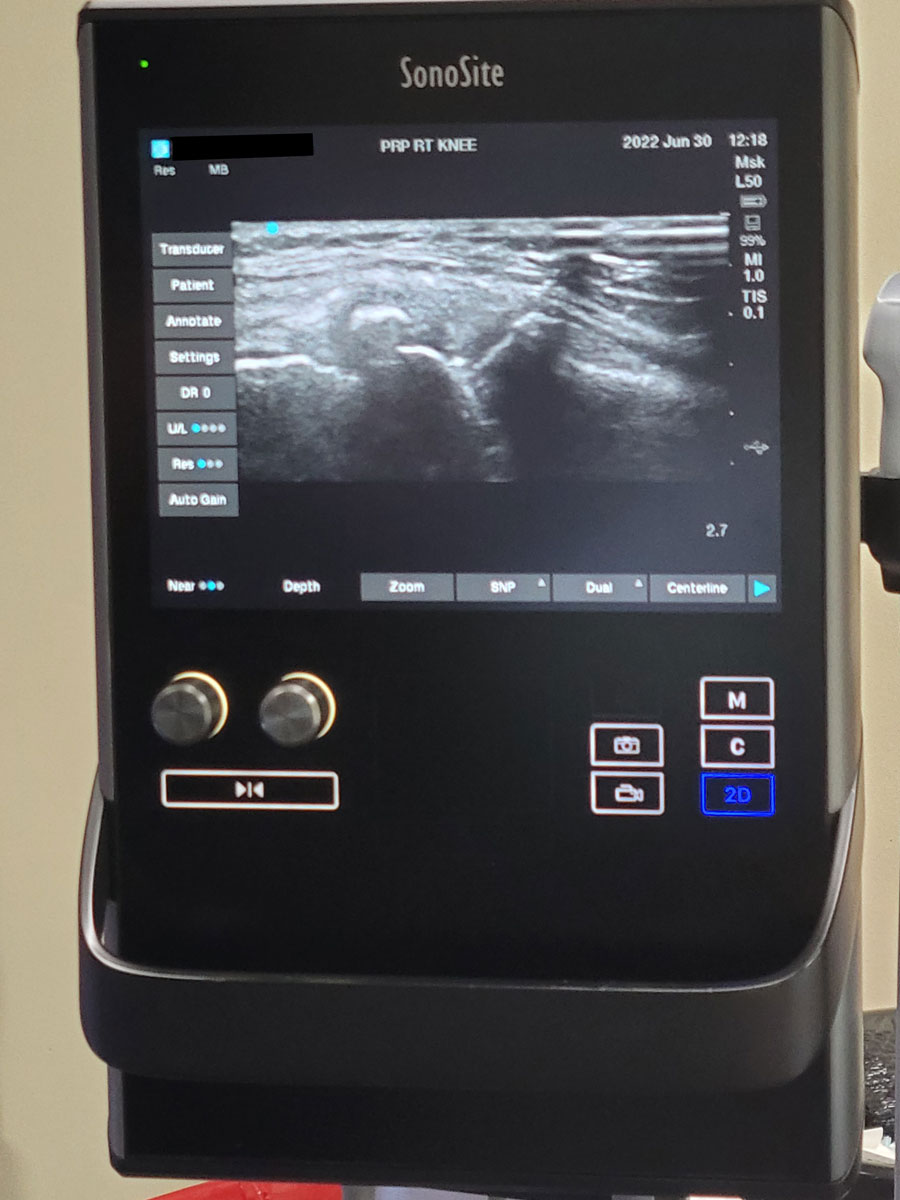 Platelet-Rich Plasma (PRP) Therapy - Spine & Orthopedic Center